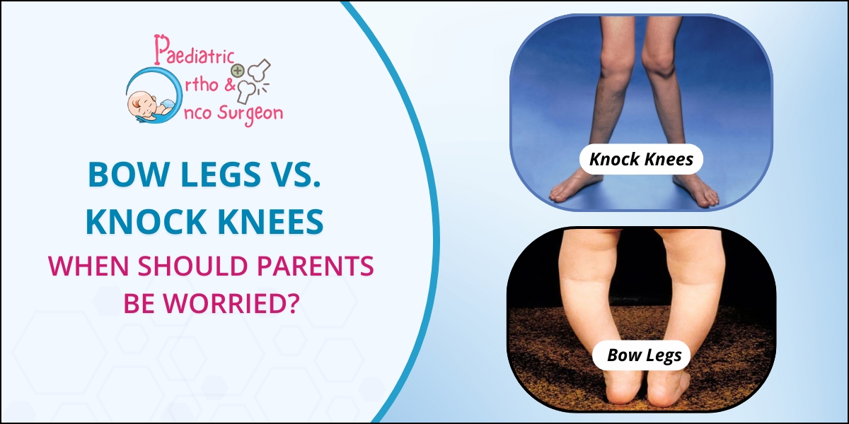 Bow Legs vs. Knock Knees: When should parents be worried? - Dr. Vinod Dubey